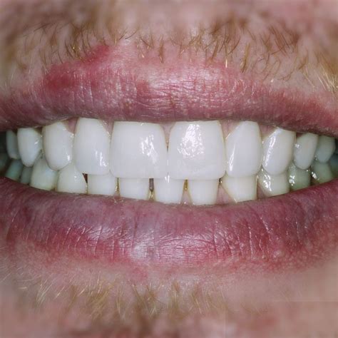 Diastema Explained Gaps In Teeth 3Dental