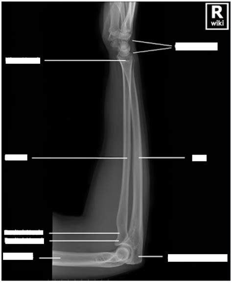 Upper Extremities Diagram Quizlet