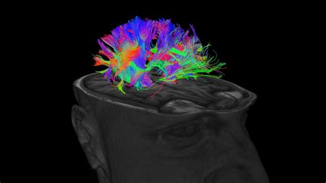 Diffusion Tensor Imaging DTI Fiber Tracking Imagilys