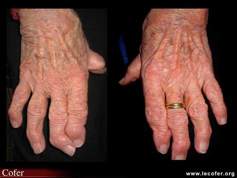 Arthrose digitale Diapothèque du COFER