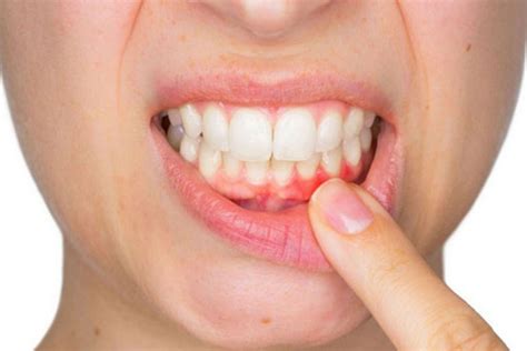 Tratamento De Gengiva Odontho Sempre