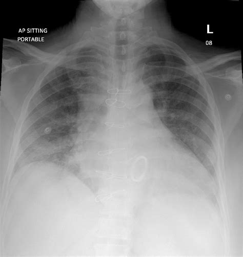 Figure 1 From Refractory Salmonella Prosthetic Valve Endocarditis