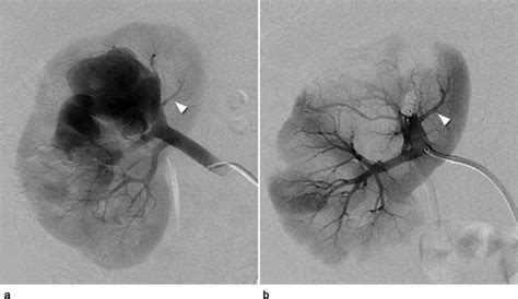 Digital Subtraction Angiography DSA During The Actual Treatment Of