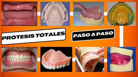 PRÓTESIS TOTALES Prótesis total dental paso a paso YouTube
