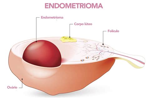 O que é Endometrioma Mulhera