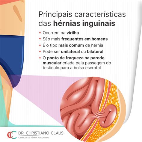 Principais características das hérnias inguinais Dr Christiano Claus