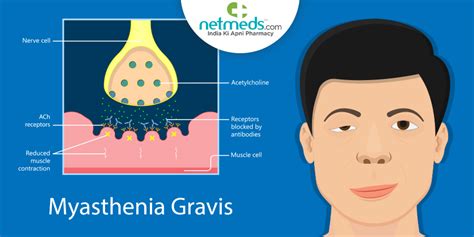 Ocular Myasthenia Gravis Ocular Mg