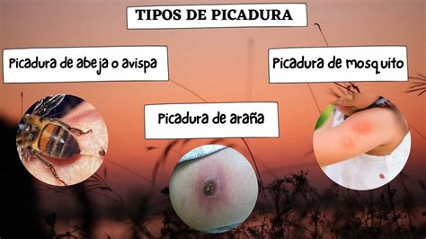 Tipos de Picadura Linda Milena León Gómez uDocz