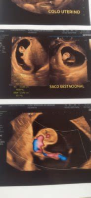 Descolamento No Saco Gestacional Babycenter