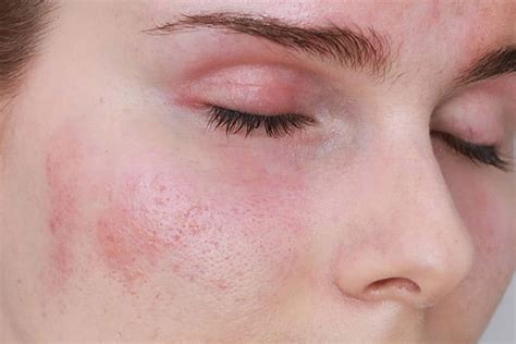 Da mặt bị ngứa nổi mẩn đỏ là bị gì và cách xử lý ra sao