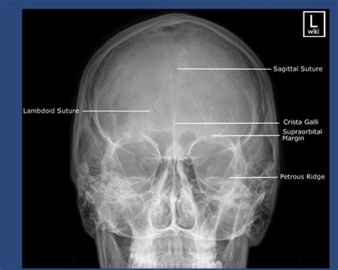 Skull And Sinuses Final Practical Flashcards Quizlet