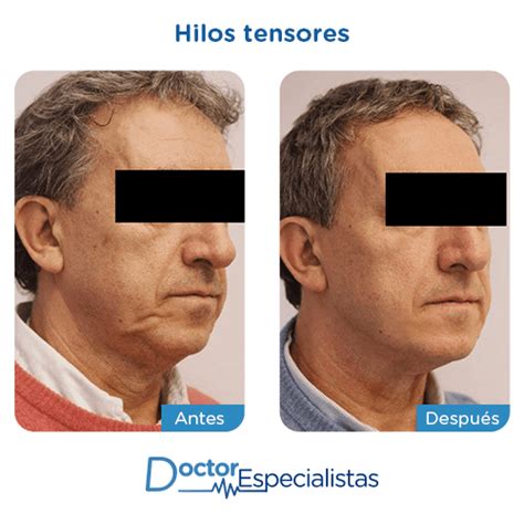 Mejores Medicos Esteticos Para Hilos Tensores Doctor Especialistas