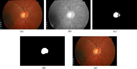 figure 4 from automated glaucoma detection using cup to disc ratio semantic scholar