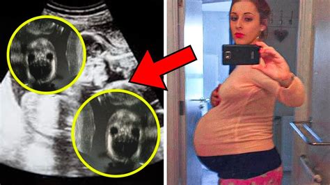 Mom S Belly Won T Stop Growing After Birth Doctor Can T Believe His