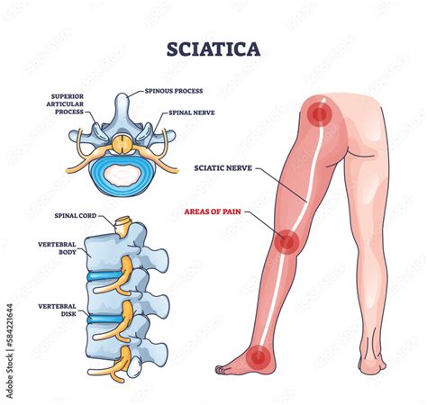 Sciatica Areas Of Pain With Anatomical Location On Leg Outline Diagram