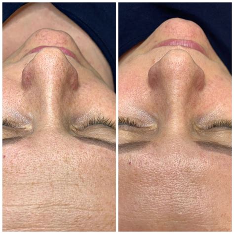 Oczyszczanie Wodorowe Twarzy Royal Beauty Clinic