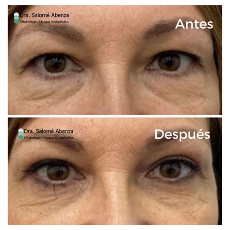 Cirugía de blefaroplastia superior e inferior transconjuntival con