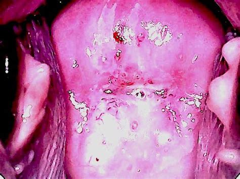 Using Human Papillomavirus HPV Detection Tests For Cervical Cancer