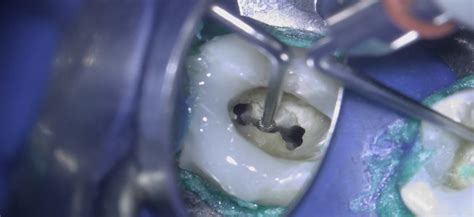 Ultrassom na Endodontia Ângelo Freire Endodontia Microscópica