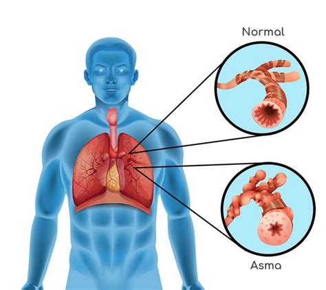 El Asma Y Las Dificultades Respiratorias Farma10 Tu Espacio De Salud
