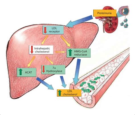Main Pathogenetic Mechanisms Responsible Of Hyperlipidemia In Nephrotic