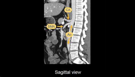 Abdominal Ct Abdominal Arteries Litfl Radiology Library