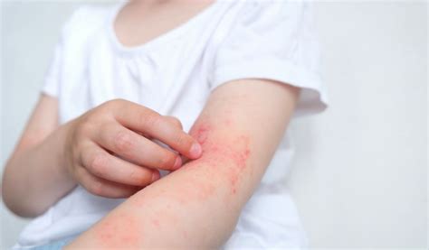 Dermatite atópica o que é causas e sintomas Hospital Nove de Julho