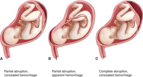 High Risk Intrapartum Class 25 Flashcards Quizlet