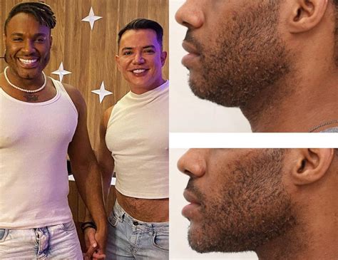 Marido mostra antes e depois do queixo de Fred Nicácio e manda recado
