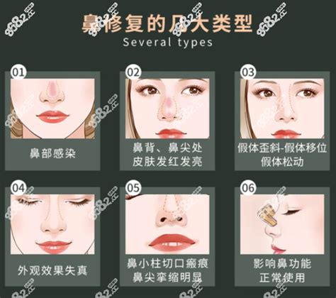 肋骨鼻三个月修复要重新取肋骨吗鼻子肋骨可以二次用吗 修复对比照 8682整形网