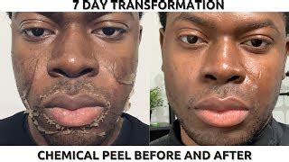 Before And After Chemical Peel Black Skin See The Wow Results