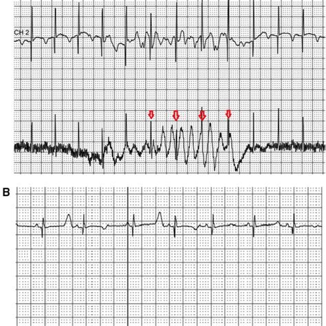 neonatal 24 h ecg recording recording artifacts simulating ventricular download scientific