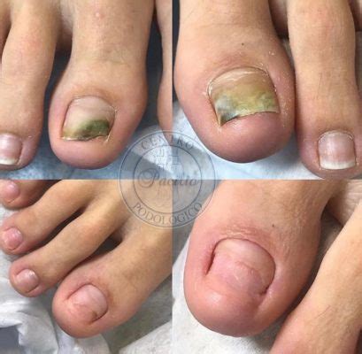 Cura Unghia Con Micosi Centro Podologico Pacilio