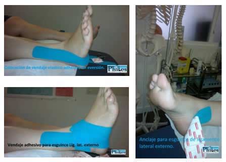 Abnutzen Heftzwecke Nackt Terapia Para Esguince De Tobillo Grado