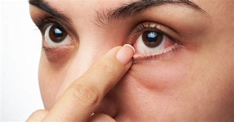 ALERJİK KONJONKTİVİT GÖZ ALERJİSİ Prof Dr Betül Tuğcu