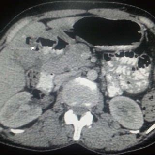 Axial Contrast Enhanced Computed Tomography Abdominal Section Shows
