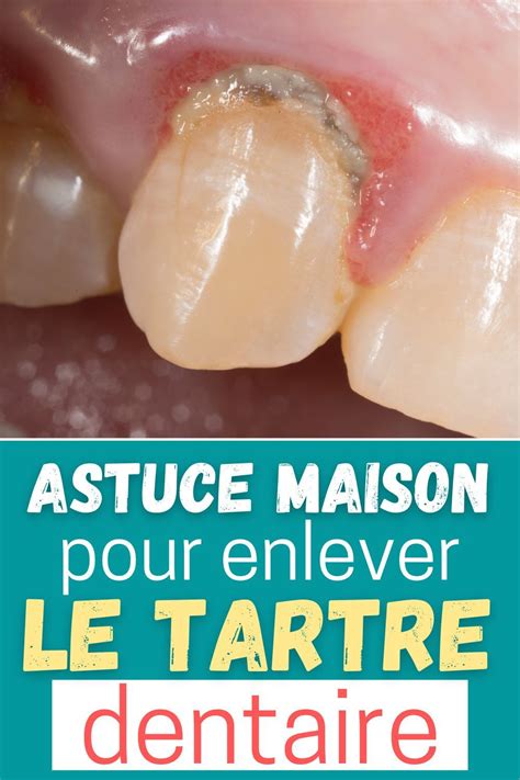 Astuce maison pour enlever le tartre dentaire soi même Tartre