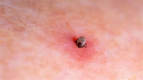 Zeckenbiss Was Tun Behandlung Und Schutz Vor Dem Stich