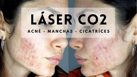 ACNÉ LASER CO2 Manchas y Cicatrices Niki Mayo Redsail Laser