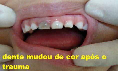 Odontologia e histórias Odontopediatria traumatismos em dentes anteriores