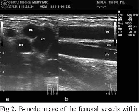 PDF Ultrasound Examination Of The Femoral And Popliteal Arteries