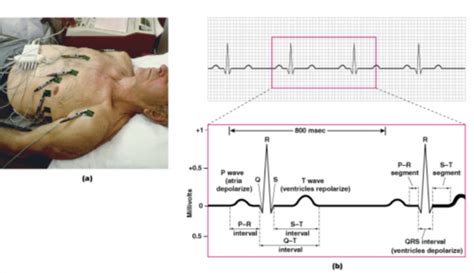 Cardiovascular System Reading Ecgs And Wigger S Diagram Flashcards
