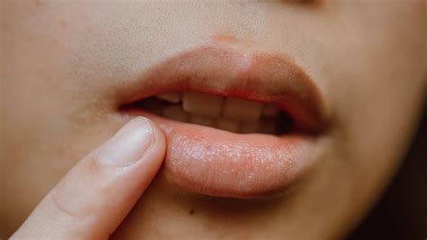 Por Qué se Resecan los Labios y Cómo Prevenirlo