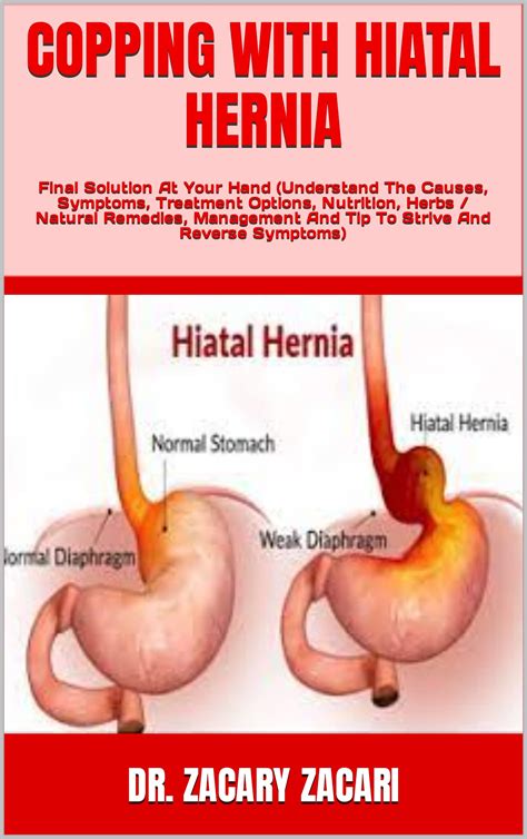 Copping With Hiatal Hernia Final Solution At Your Hand By Dr Zacary