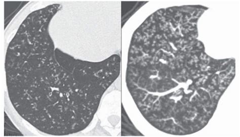 Small Airway Diseases Radiology Key