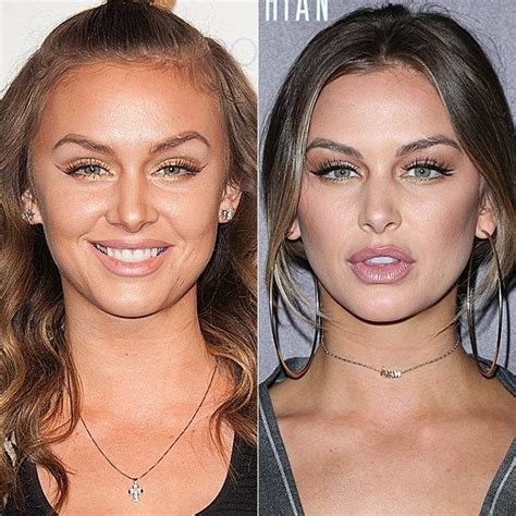 Celebrity Lip Injection Lip Injections Cheek Fillers Lip Fillers