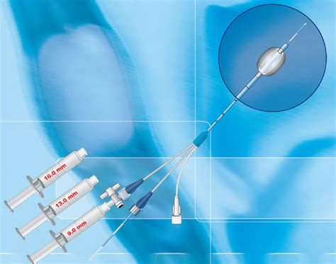 Catéter de extracción de cálculos GEB xx series Asept Inmed