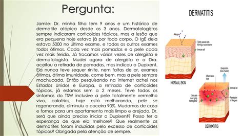 A Dermatite Pode Ser Induzida Pelo Excesso De Corticoide T Pico Devo