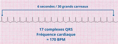 Calculer la Fréquence Cardiaque Avec un ECG AVF Biomedical