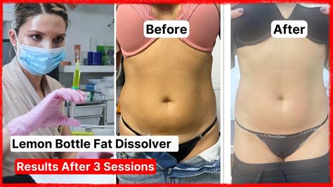 Lemon Bottle Fat Dissolving Injections Before And After YouTube